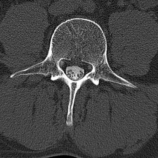 Myelographie / Myelo CT ǀ UKD